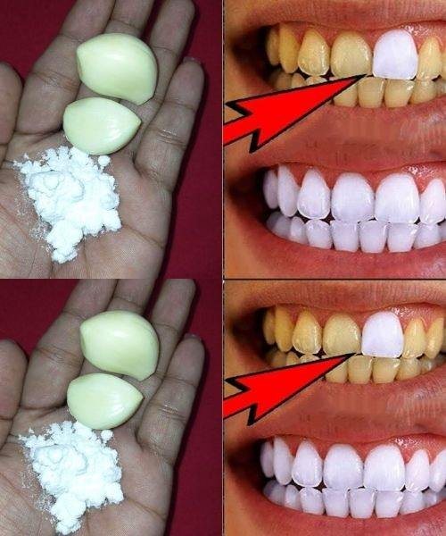 Garlic: A Surprising Ingredient for Making Teeth Whiter - My Blog